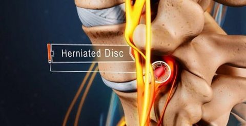 Disc Injuries - Barrick Family Chiropractic